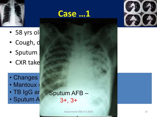 BRONCHIECTASIS 2018 | PPT
