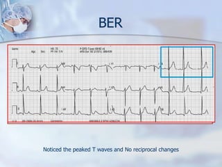 Ber | PPTX | Heart and Cardiovascular Diseases | Diseases and Conditions