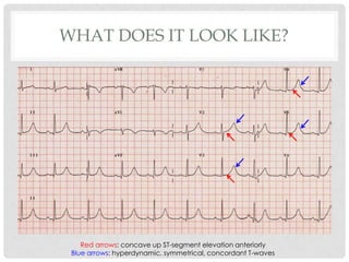 Benign Early Repolarization | PPTX | Heart and Cardiovascular Diseases ...