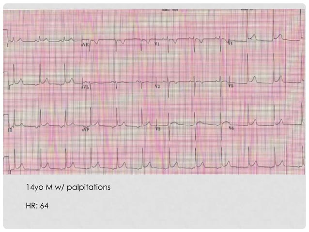 Benign Early Repolarization | PPTX | Heart and Cardiovascular Diseases ...