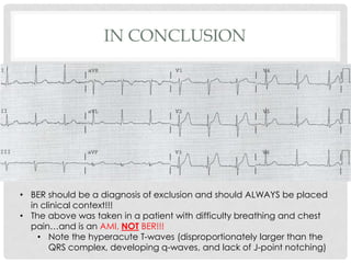 Benign Early Repolarization