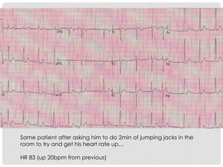 Benign Early Repolarization