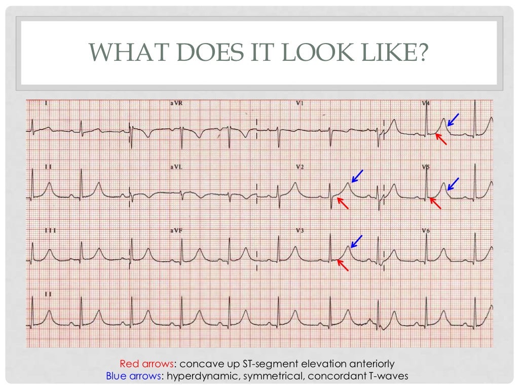 Benign Early Repolarization