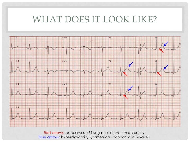 Benign Early Repolarization
