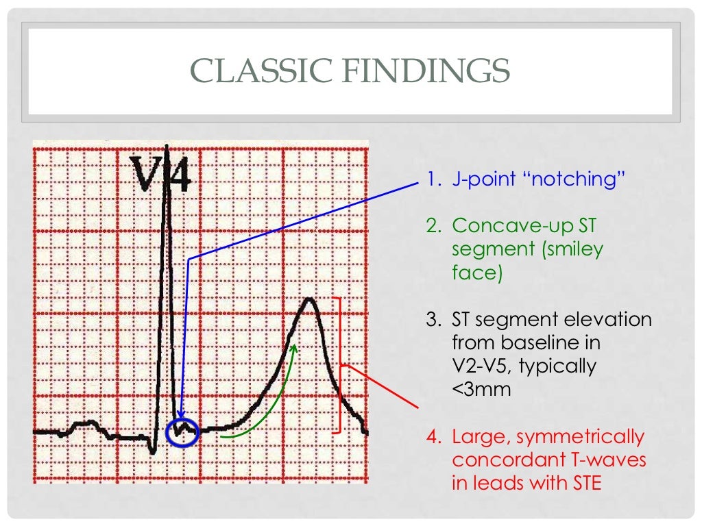 Benign Early Repolarization