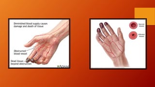 Berger's disease | PPTX