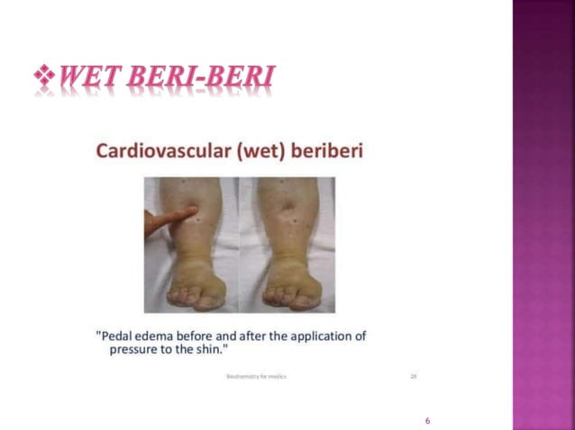 Beri beri | PPTX | Heart and Cardiovascular Diseases | Diseases and ...