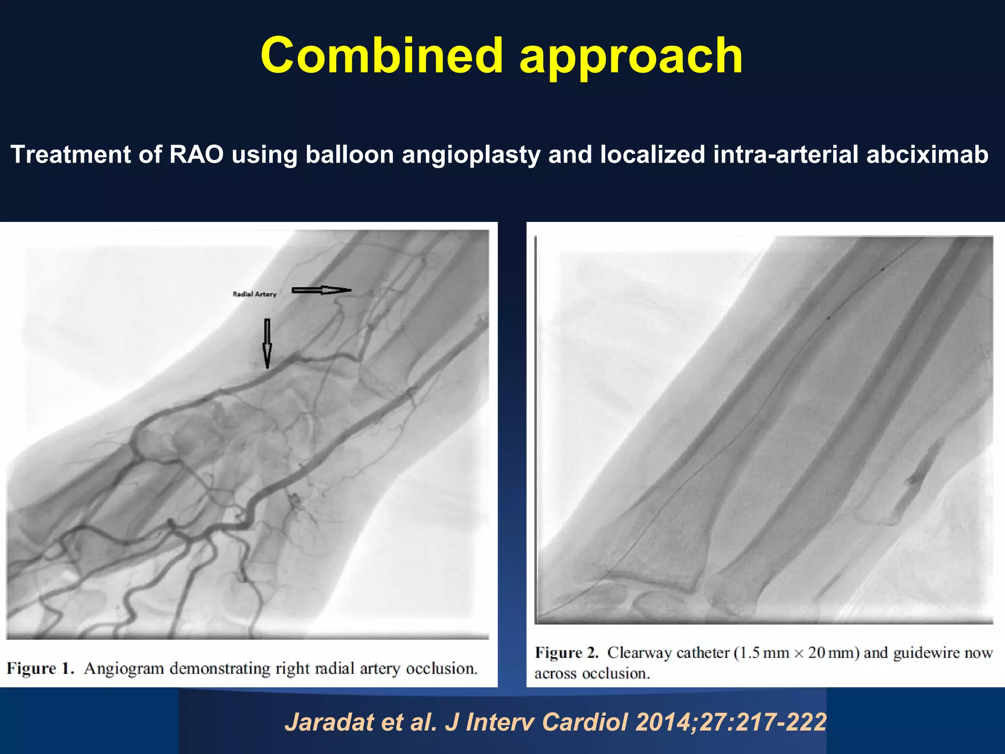 Bernat I - AIMRADIAL 2014 Technical - Radial artery occlusion | PPT