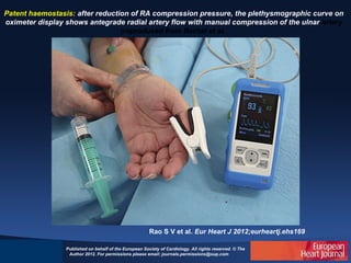 Bernat I - AIMRADIAL 2014 Technical - Radial artery occlusion | PPT
