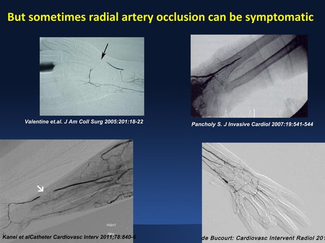 Bernat I - AIMRADIAL 2014 Technical - Radial artery occlusion | PPT