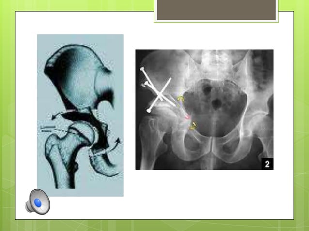 Bernese periacetabular osteotomy | PPSX | Bone and Joint Conditions ...