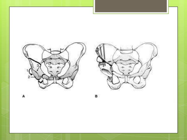 Bernese periacetabular osteotomy original | PPTX | Bone and Joint ...