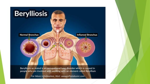 Beryllium toxicity | PPTX