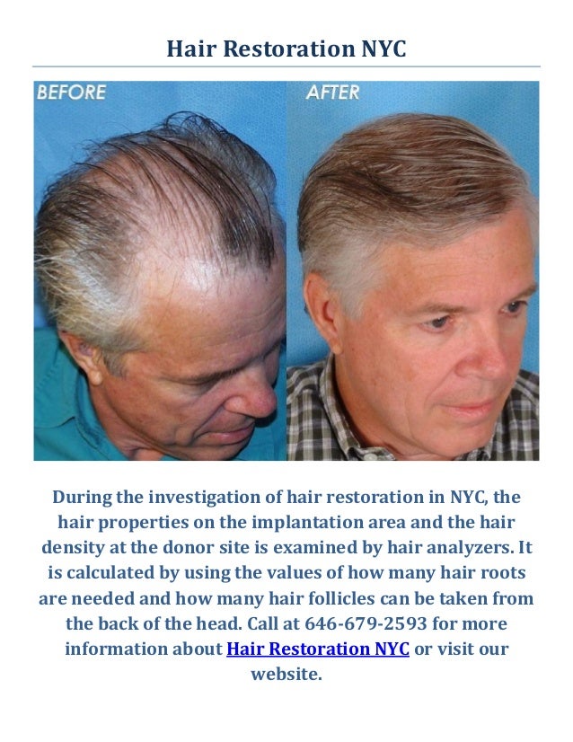 Best Hair Transplant Nyc Revive Fue Hair Restoration In New York