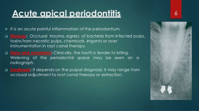 Acute Apical Periodontitis