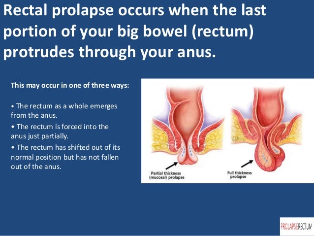 Best Rectal Prolapse Treatment | PPTX