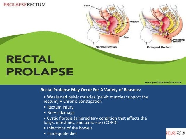 Best Rectal Prolapse Treatment | PPTX