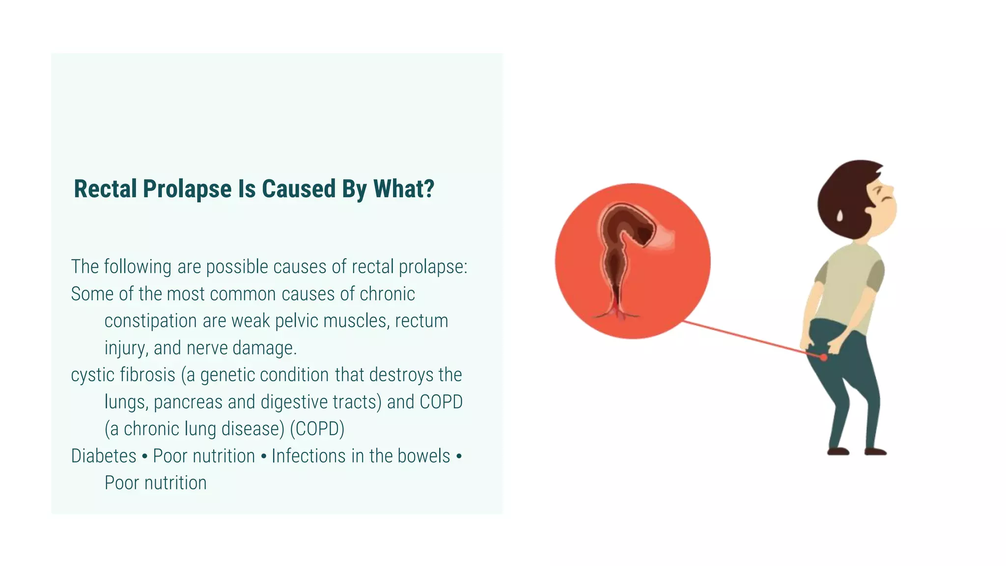 Best Rectal Prolapse Treatment | PPT