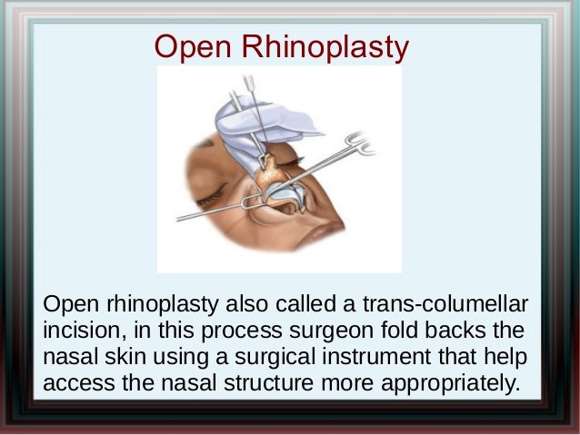 BestrhinoplastyWhich One Is Better- Open Rhinoplasty OR Closed Rhinop…