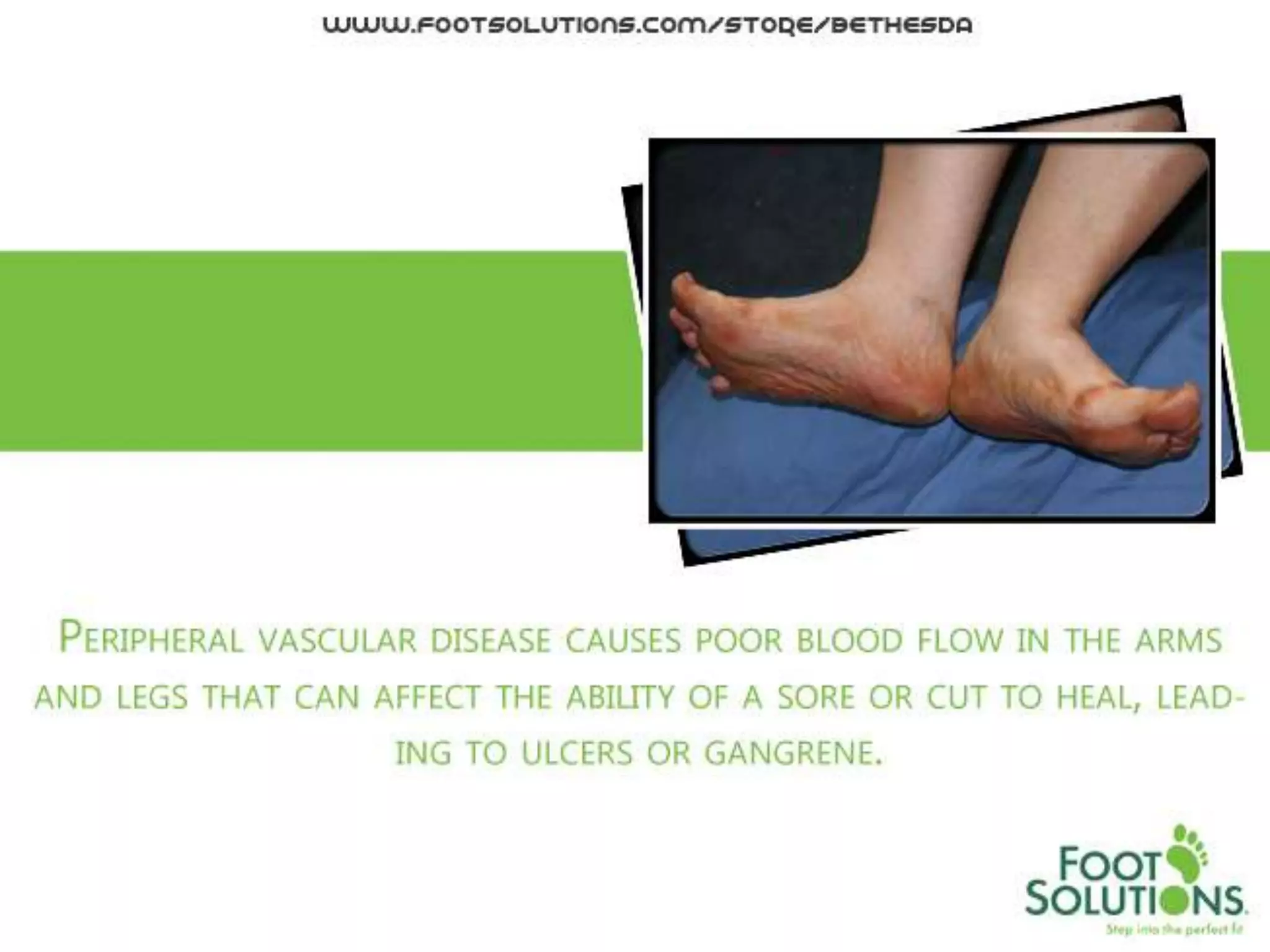 Diabetic Foot Problems | PPTX