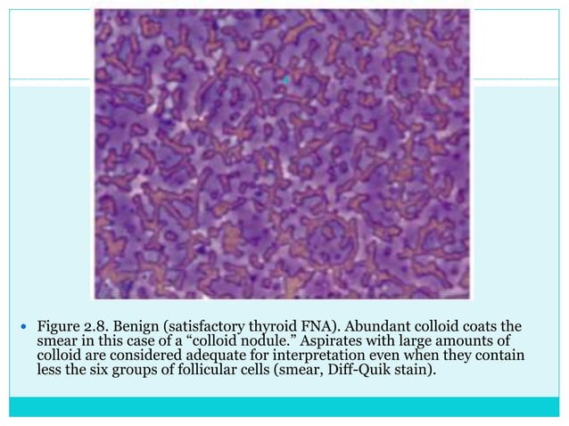 Bethesda System for thyroid cytopathology | PPTX | Thyroid Disorders ...