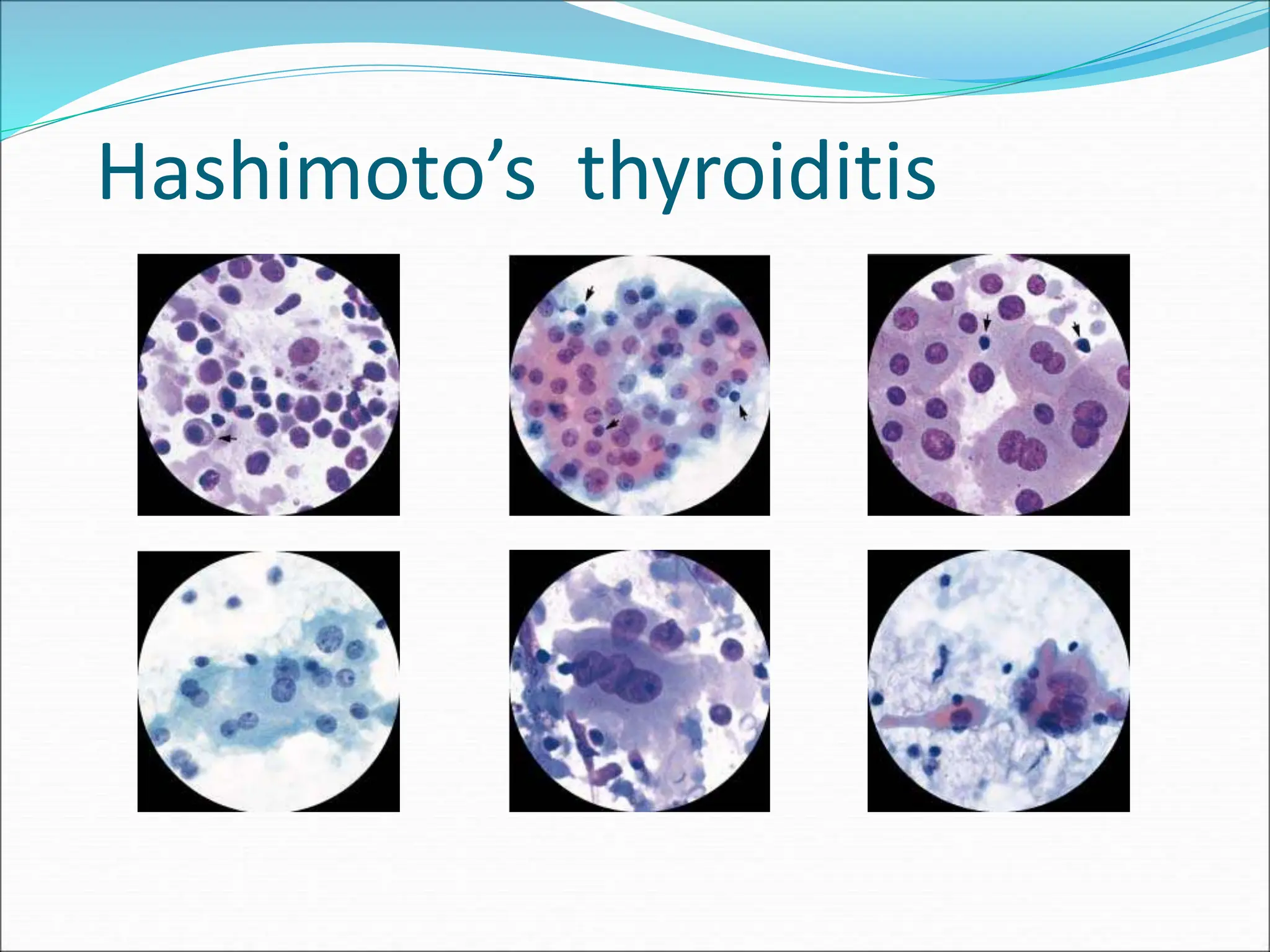 The Bethesda System for Thyroid Cytopathology.ppt