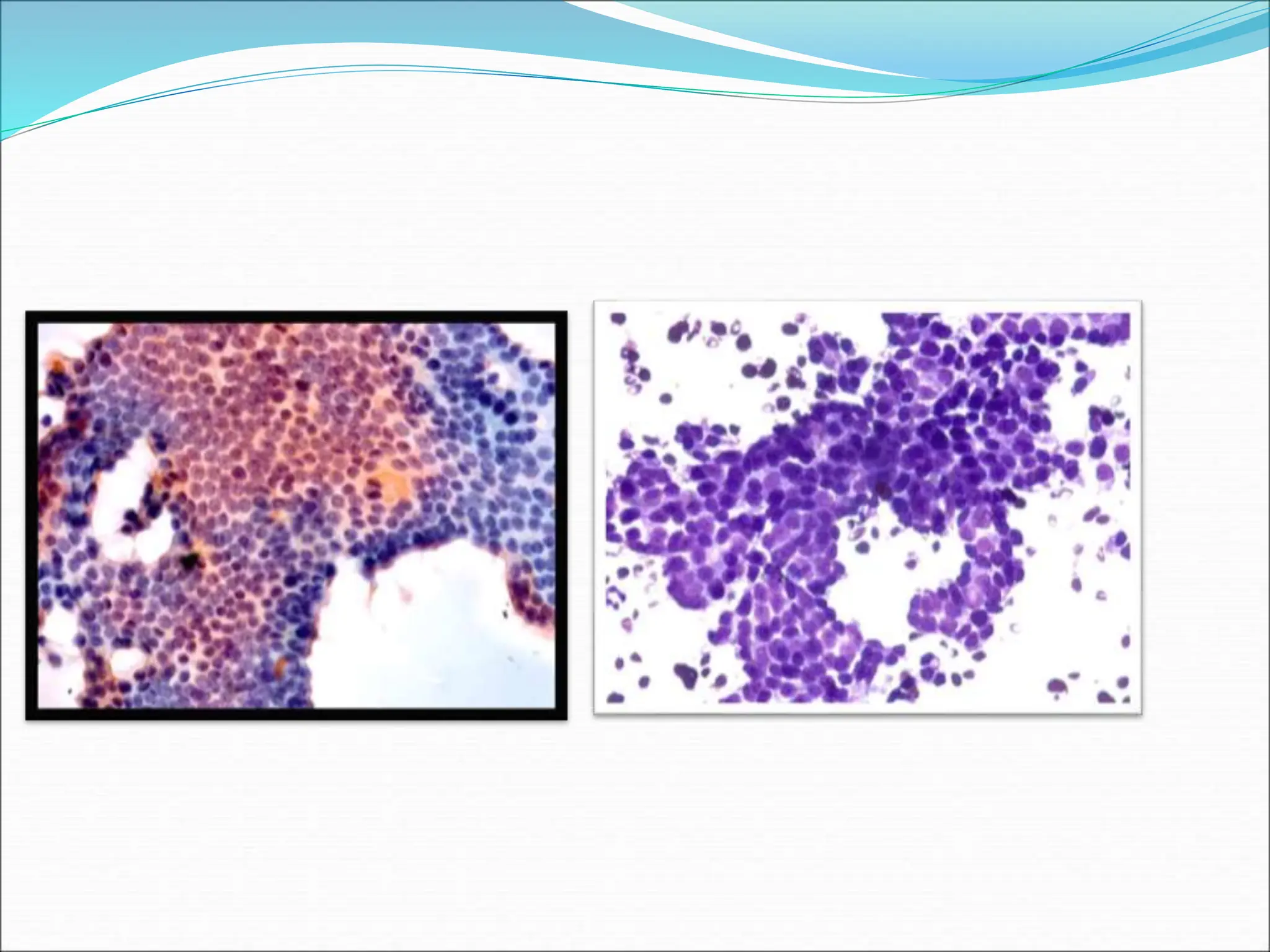 The Bethesda System for Thyroid Cytopathology.ppt