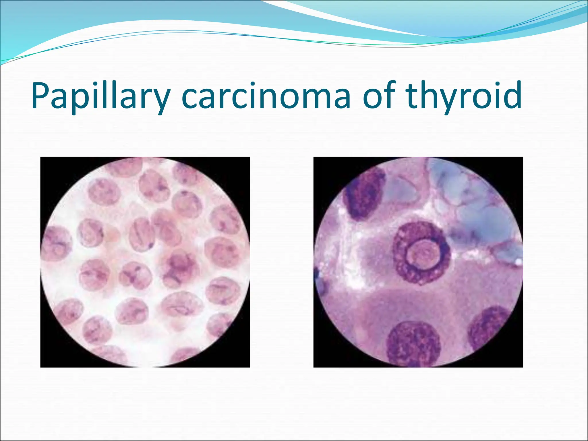 The Bethesda System for Thyroid Cytopathology.ppt