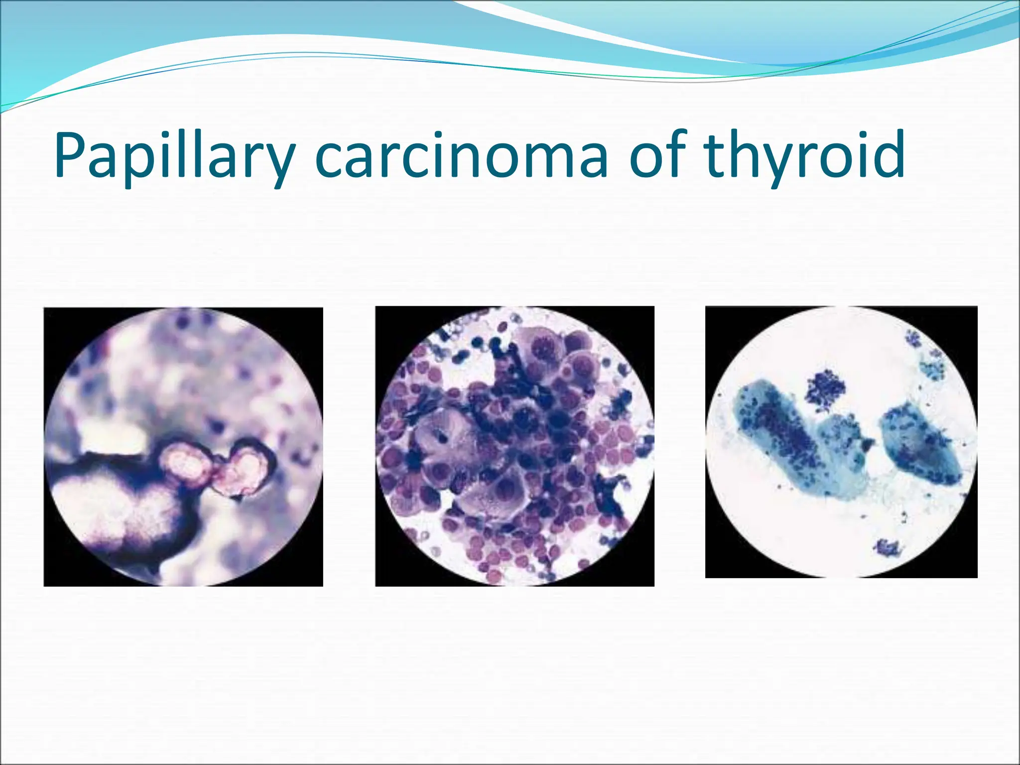 The Bethesda System for Thyroid Cytopathology.ppt