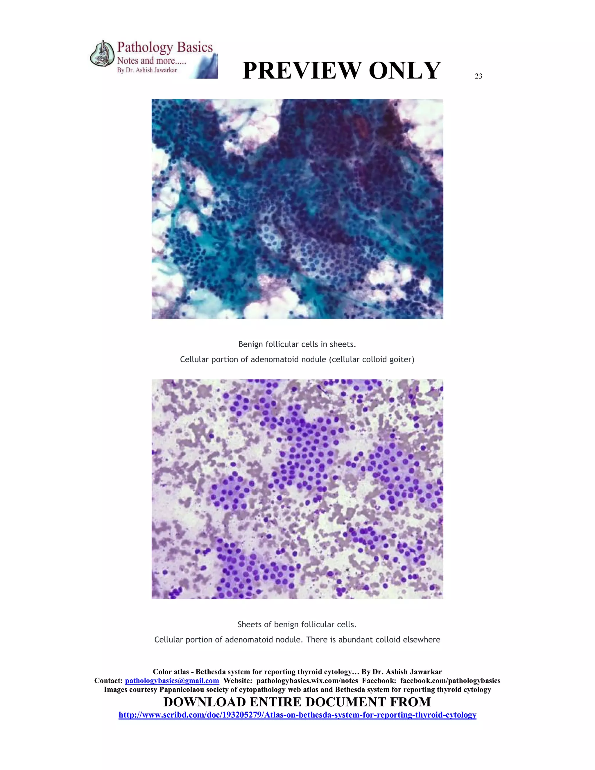 color atlas on bethesda system for reporting thyroid cytology | PDF
