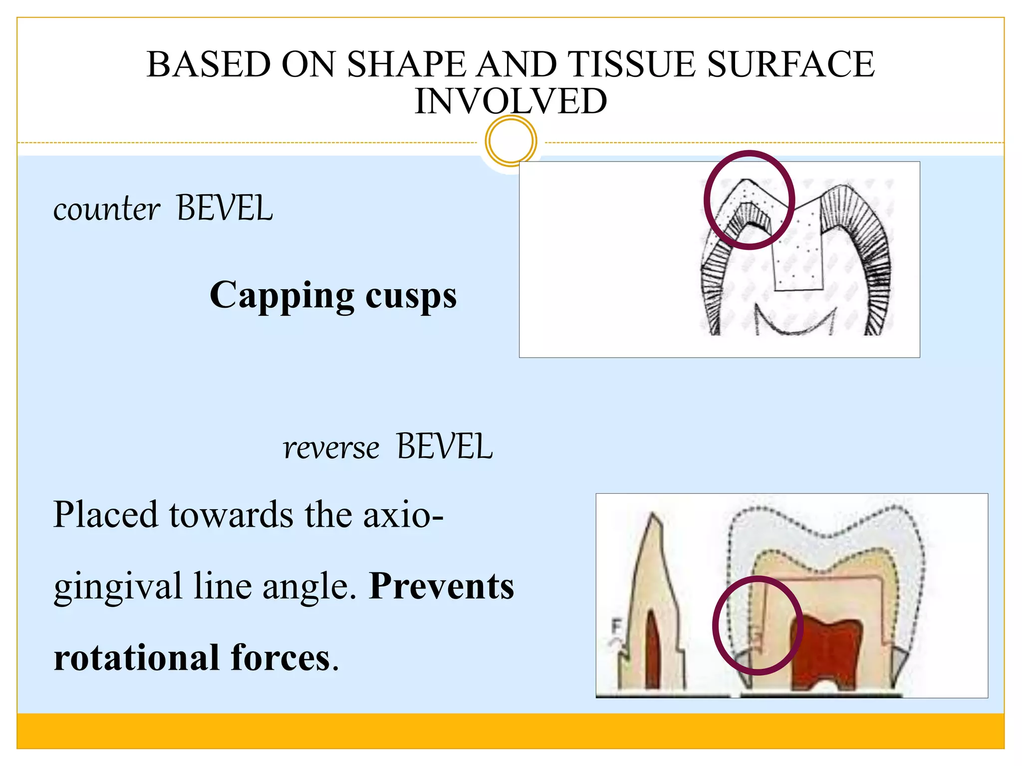 Bevels in Dental Restorations | PPTX
