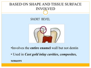 Bevels in Dental Restorations | PPTX