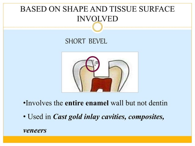 Bevels in Dental Restorations | PPTX | Dental Health | Diseases and ...