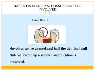 Bevels in Dental Restorations