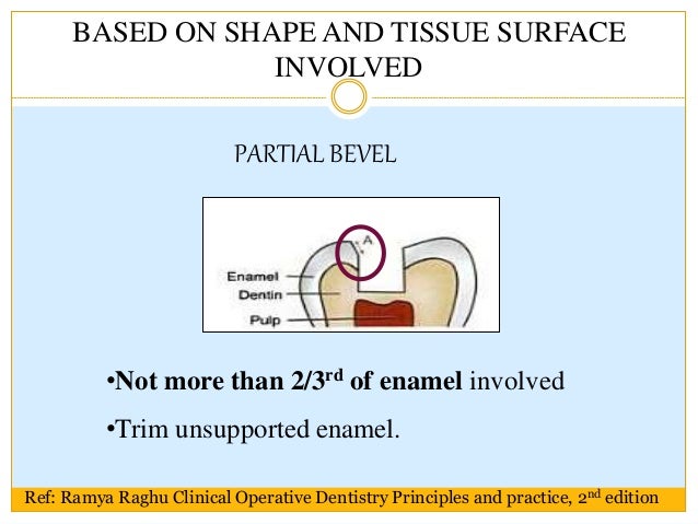 Bevels in Dental Restorations