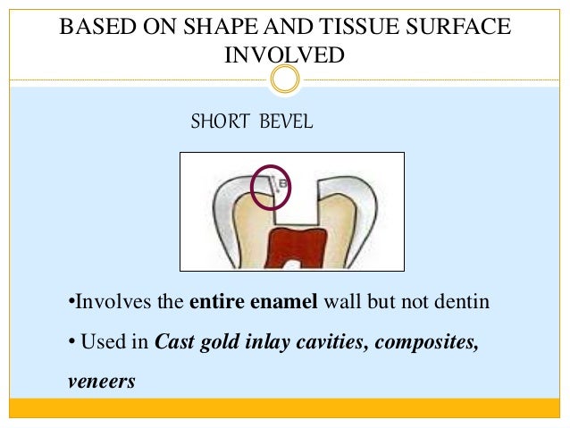 Bevels in Dental Restorations