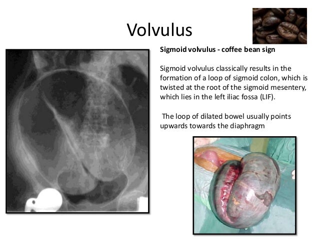 Sigmoid volvulus: "coffee bean" sign | Sigmoid colon, Radiographer ...