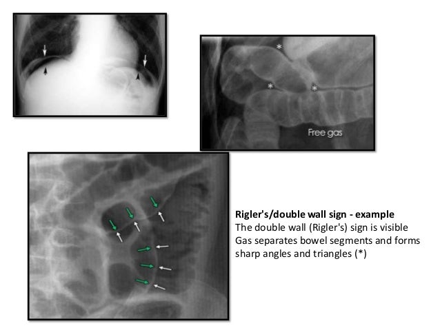Beyond chest in radiographs