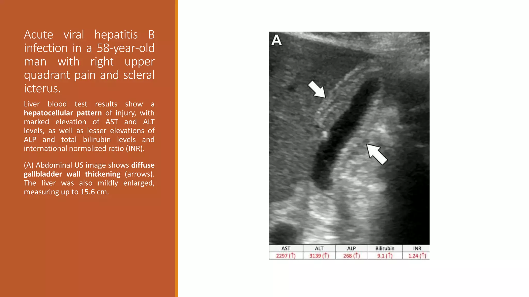 Beyond LFT - A Radiologist’s Guide to the Liver Blood Tests | PPTX ...