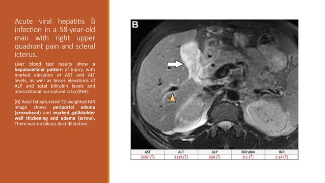 Beyond LFT - A Radiologist’s Guide to the Liver Blood Tests | PPTX ...
