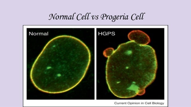Progeria Power Point Edited