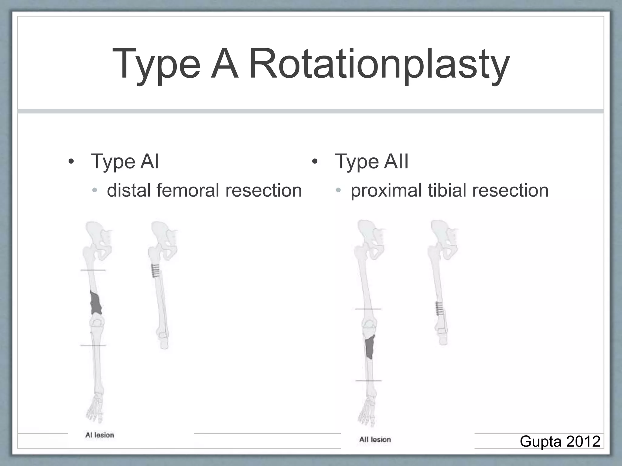 Rotationplasty | PPTX