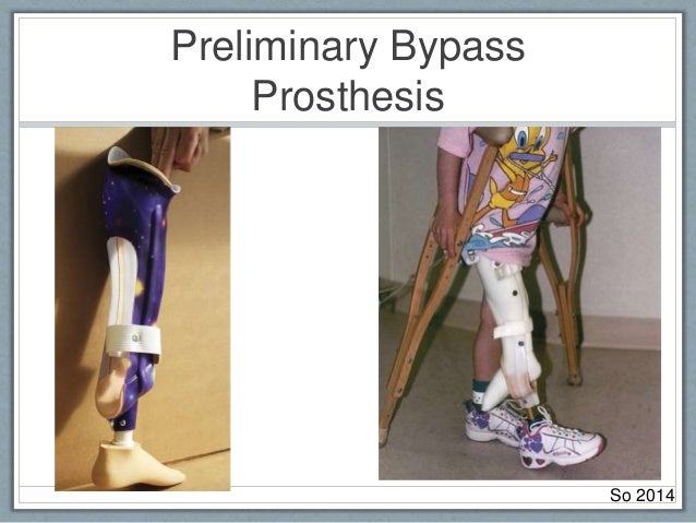 Rotationplasty Prosthesis