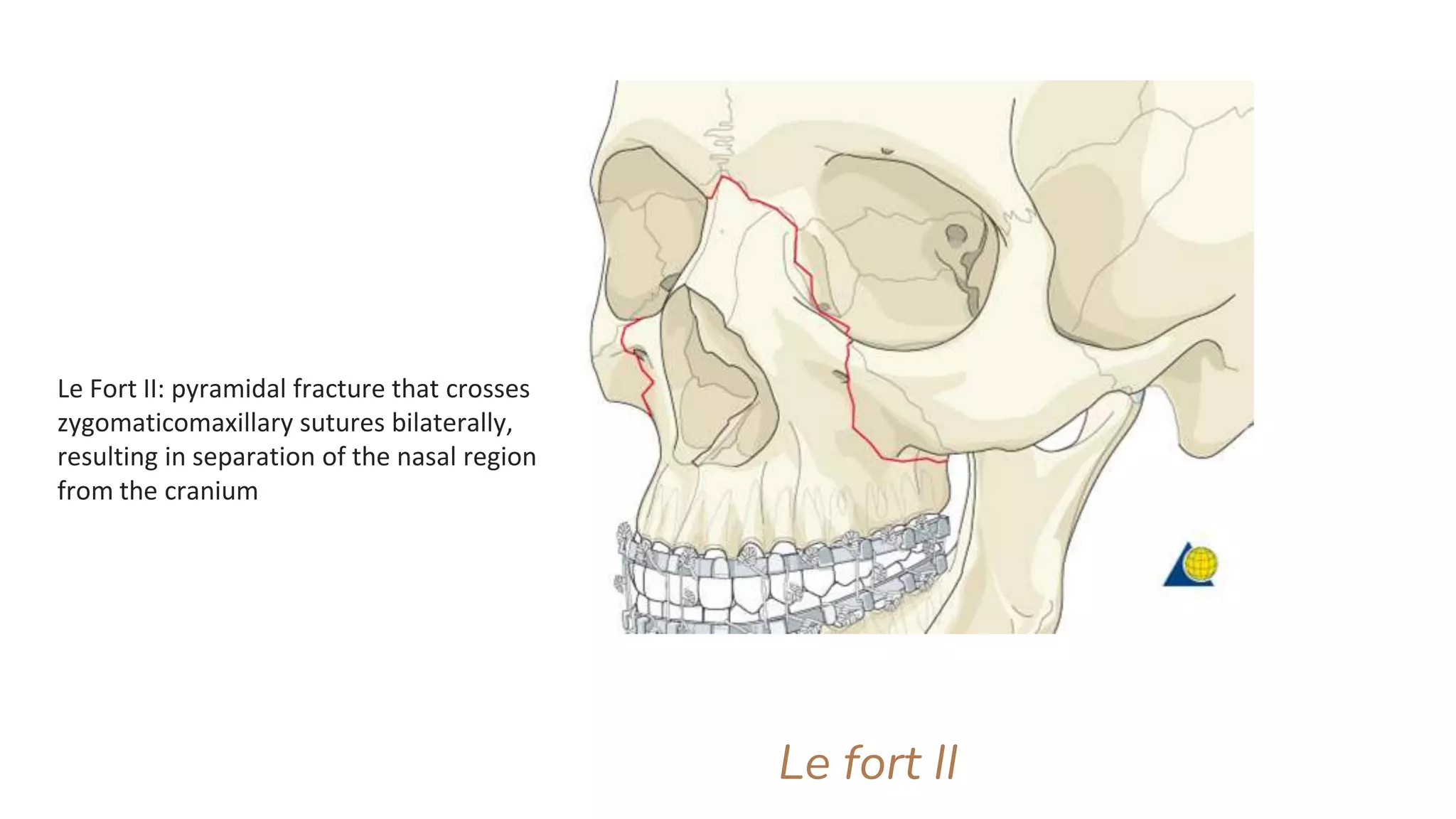 B_Fraktur Orokraniofasial.pptx