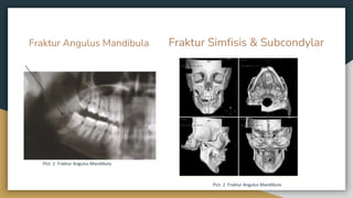 B_Fraktur Orokraniofasial.pptx