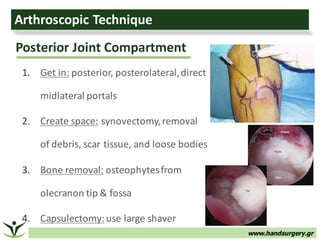 Arthroscopic management of arthritic elbow | PDF
