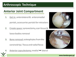 Arthroscopic management of arthritic elbow | PDF