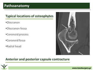 Arthroscopic management of arthritic elbow | PPT