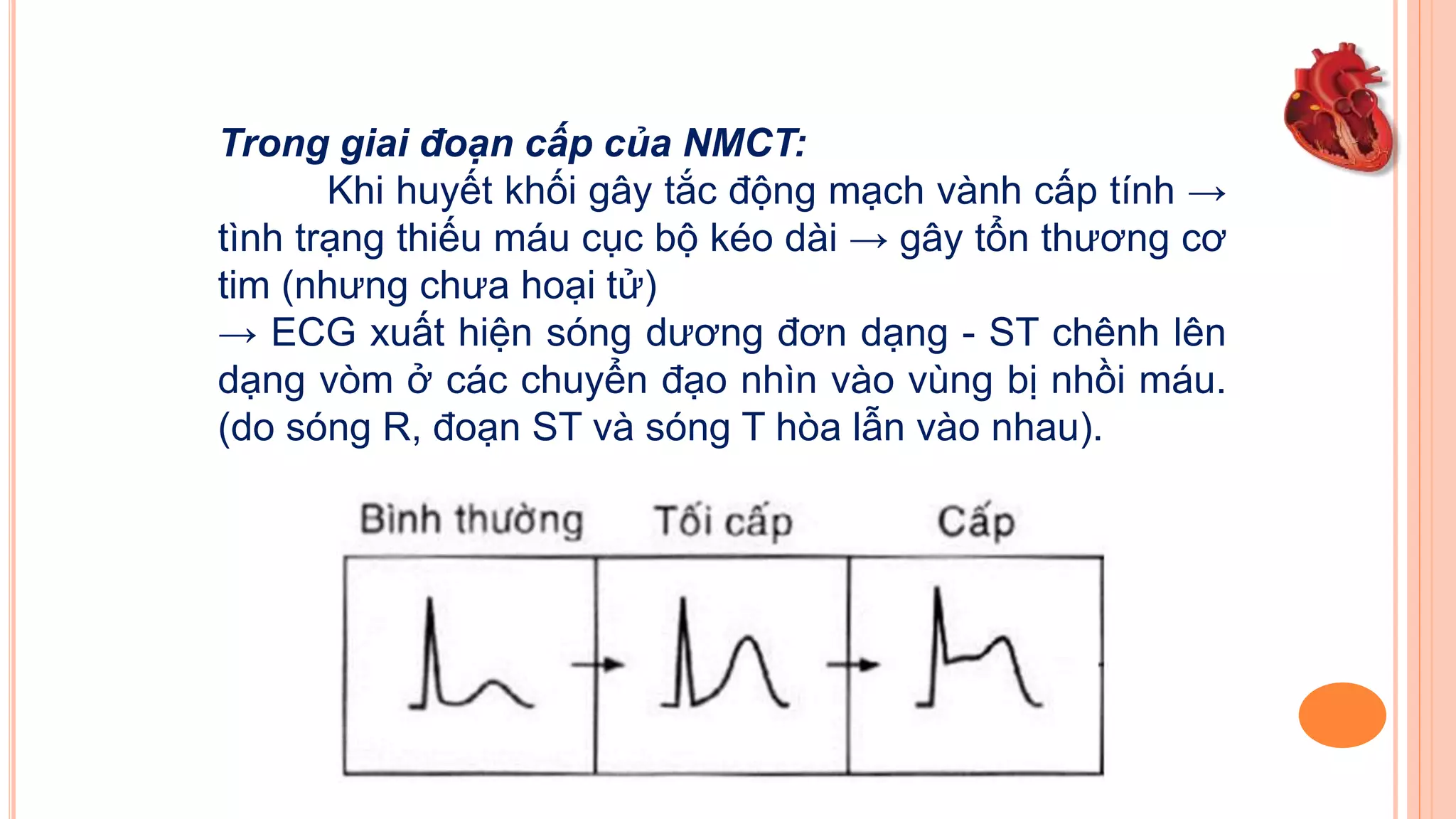 ĐIỆN TÂM ĐỒ BỆNH TIM THIẾU MÁU CỤC BỘ | PPT