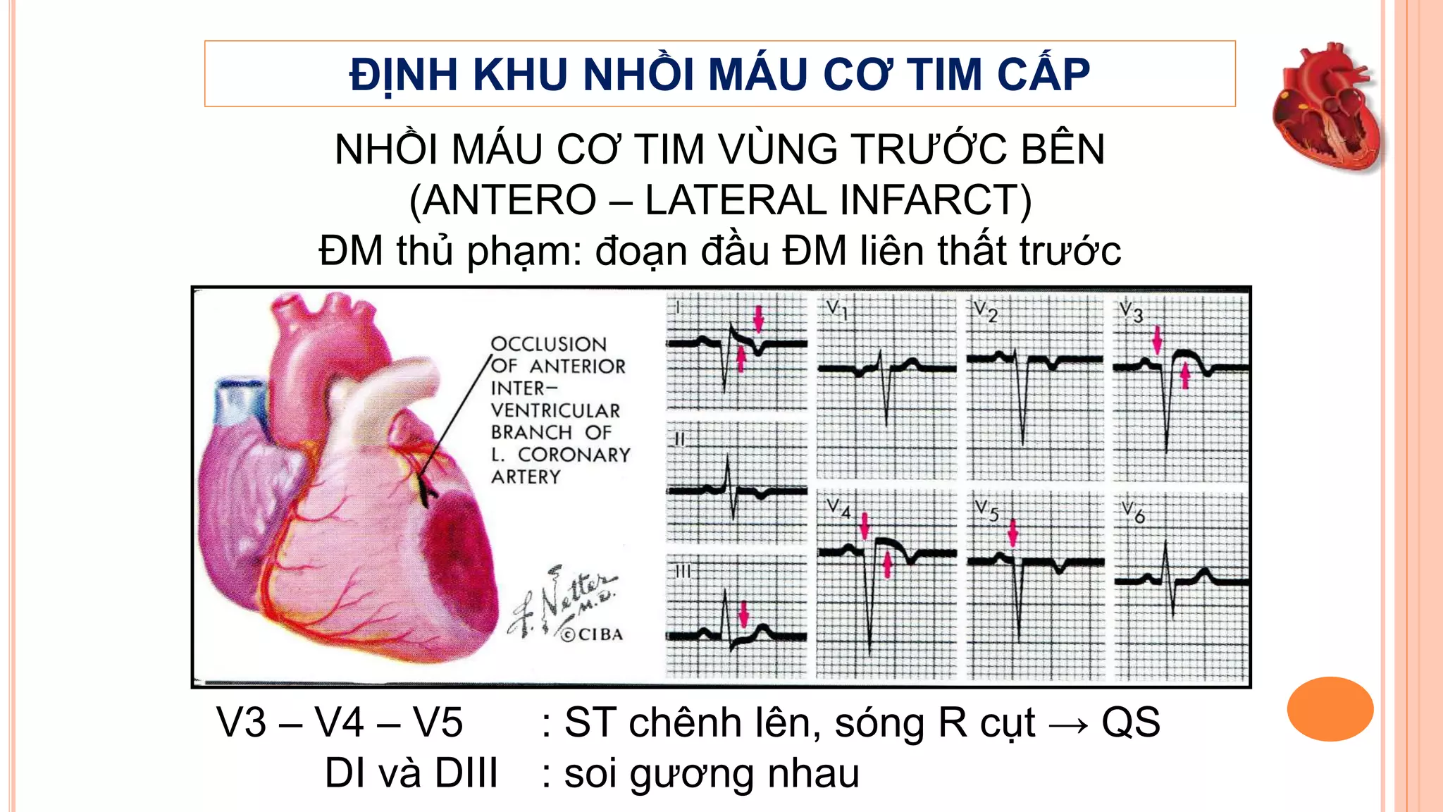 ĐIỆN TÂM ĐỒ BỆNH TIM THIẾU MÁU CỤC BỘ | PPT